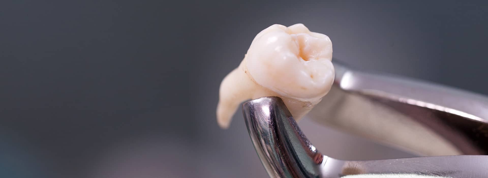 Tooth Extraction in Greeley, CO | Clearwater Dentistry